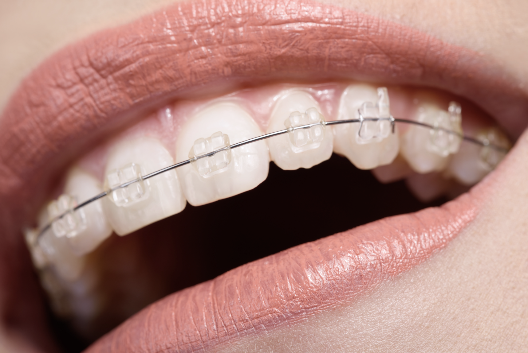 Sapphire braces store